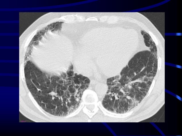 Imaging of IPF | PPT