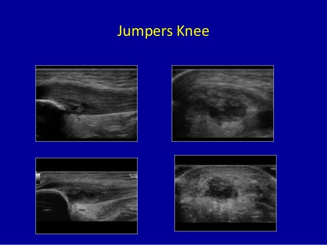 Imaging Of Knee By Mr And Usg