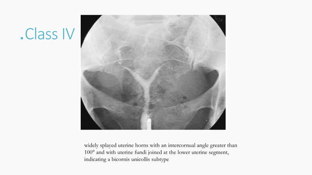 Imaging of Müllerian Duct Anomalies(MDAs).pptx