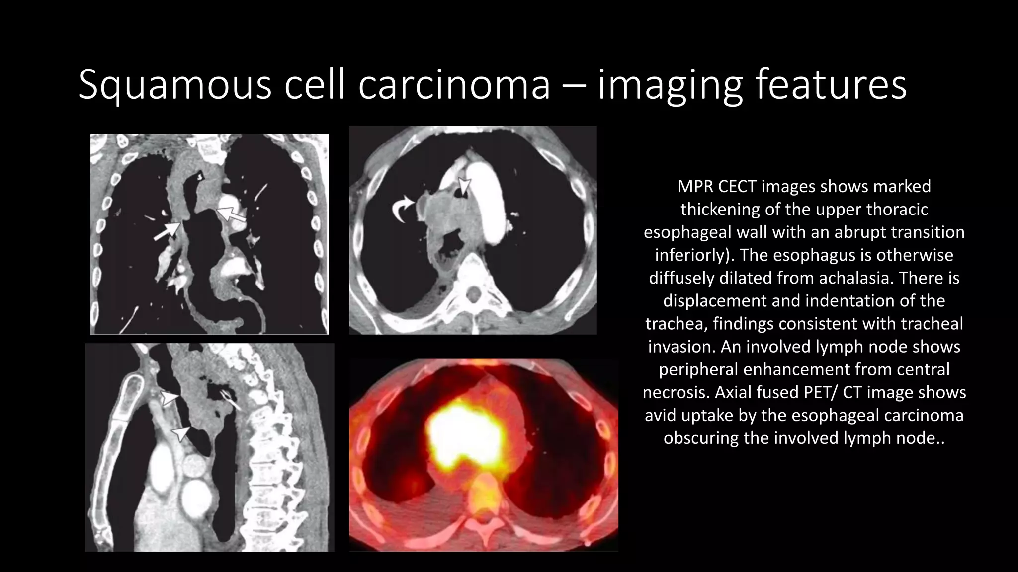 Imaging of neoplastic lesions of esophagus including staging | PPT