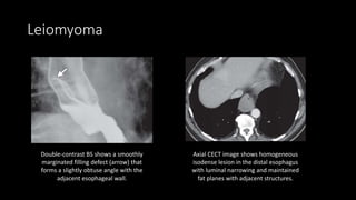 Imaging of neoplastic lesions of esophagus including staging | PPTX