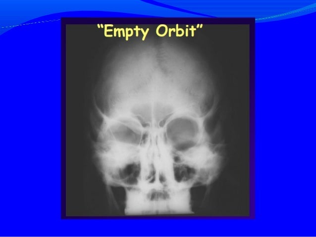 Imaging of neurocutaneous syndrome overview