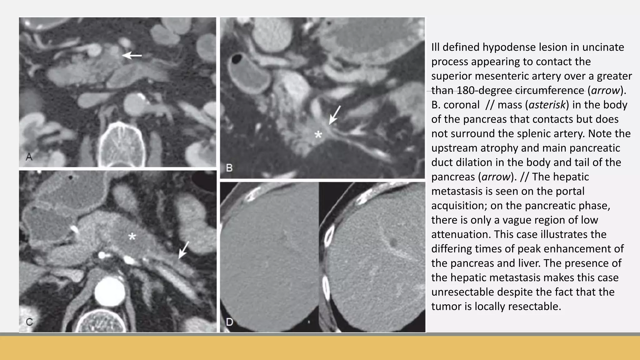 Imaging of non endocrine tumour of pancreas | PPTX