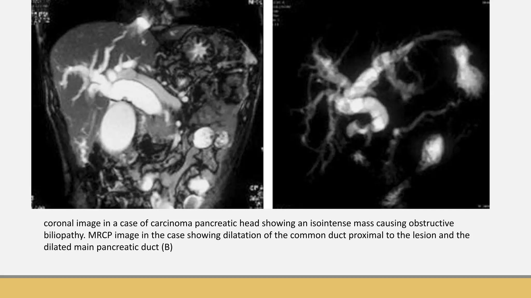 Imaging of non endocrine tumour of pancreas | PPTX