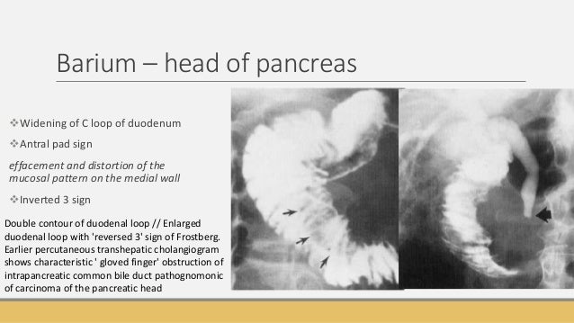 Imaging of non endocrine tumour of pancreas
