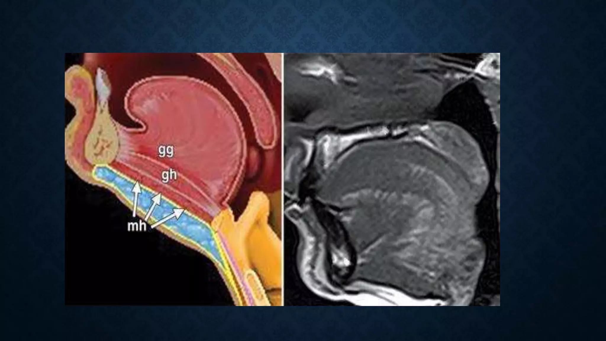 IMAGING OF ORAL CAVITY CANCER-1.pptx