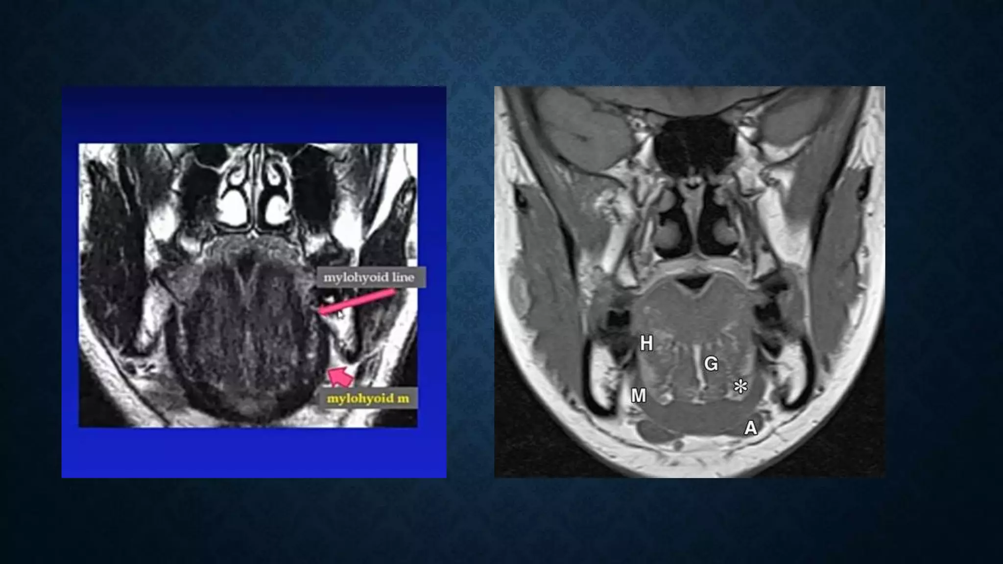 IMAGING OF ORAL CAVITY CANCER-1.pptx