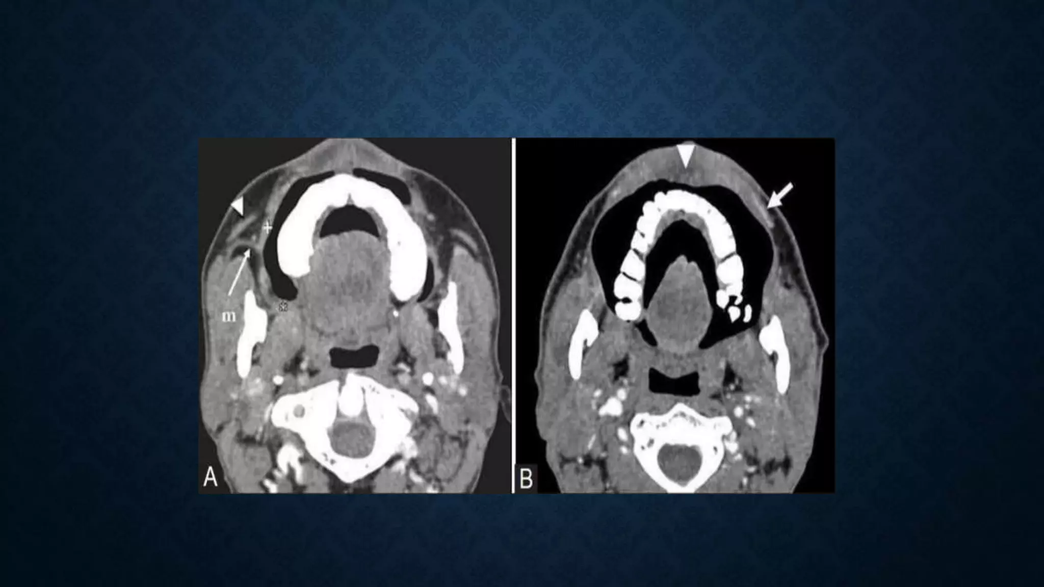 IMAGING OF ORAL CAVITY CANCER-1.pptx
