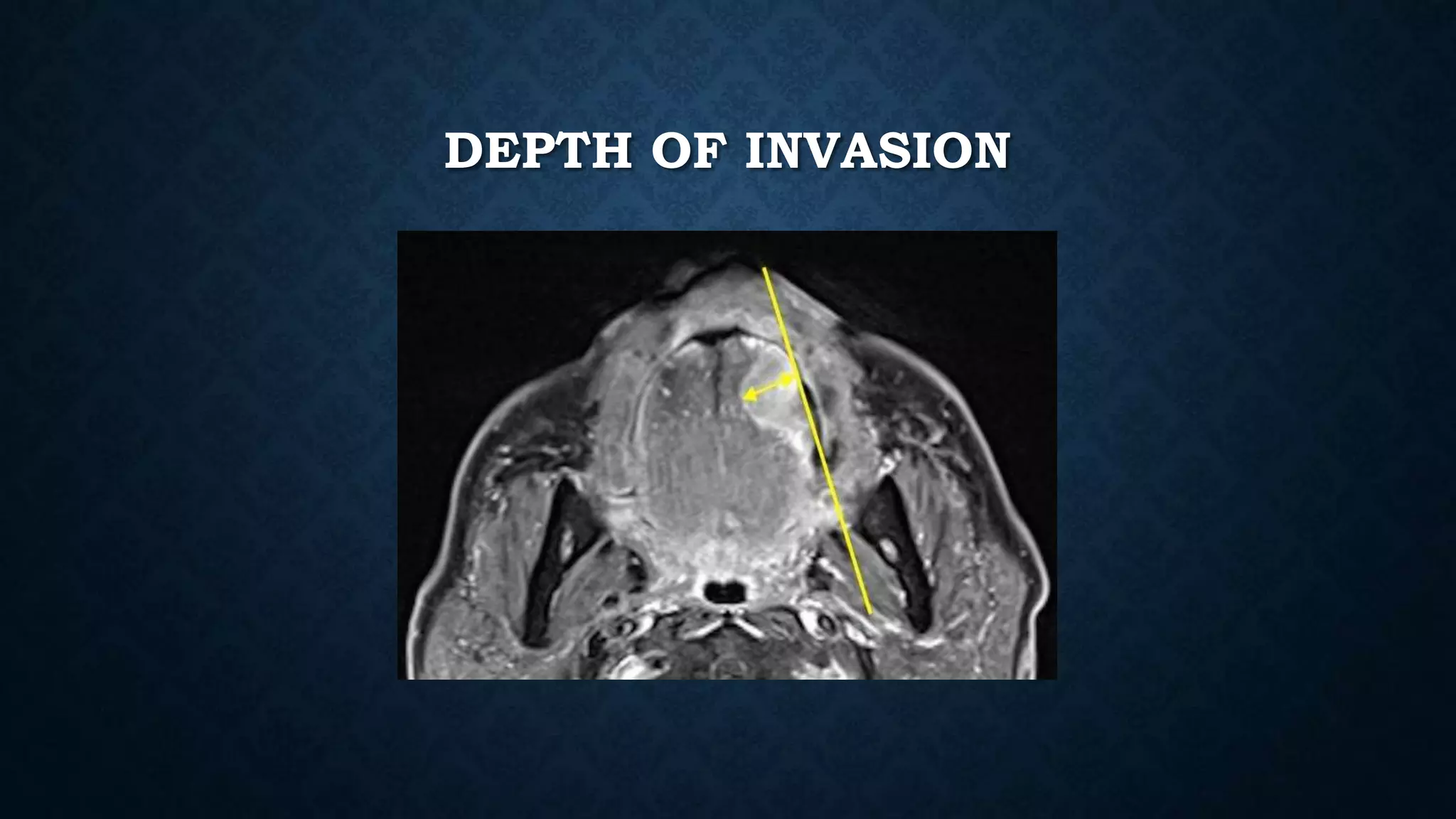 IMAGING OF ORAL CAVITY CANCER-1.pptx