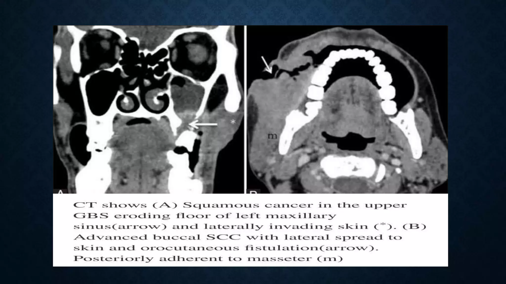 IMAGING OF ORAL CAVITY CANCER-1.pptx
