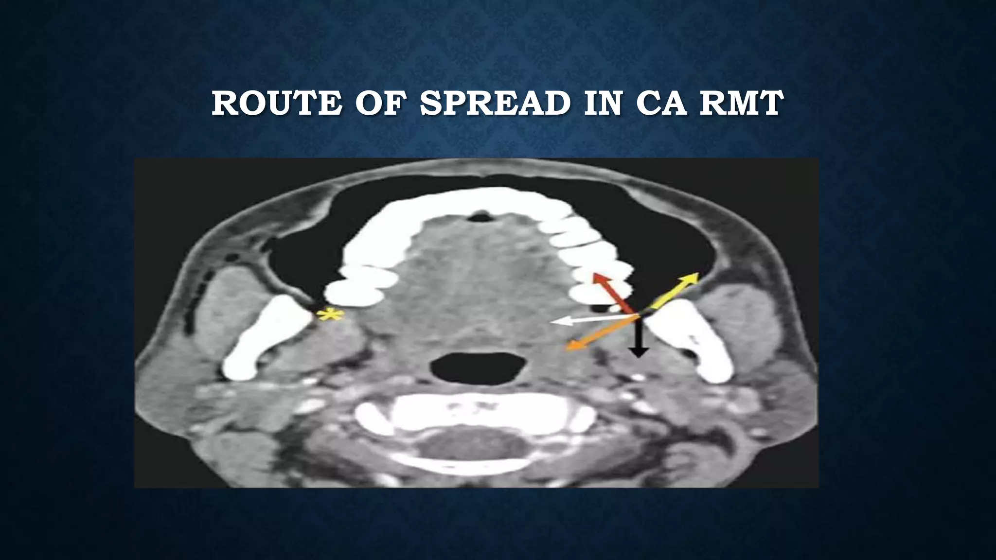 IMAGING OF ORAL CAVITY CANCER-1.pptx