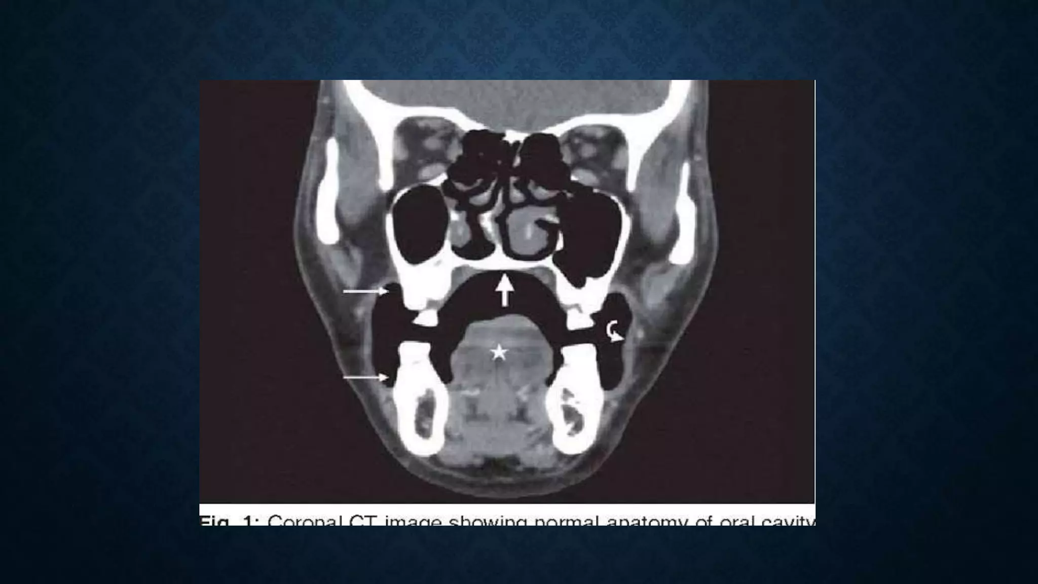 IMAGING OF ORAL CAVITY CANCER-1.pptx