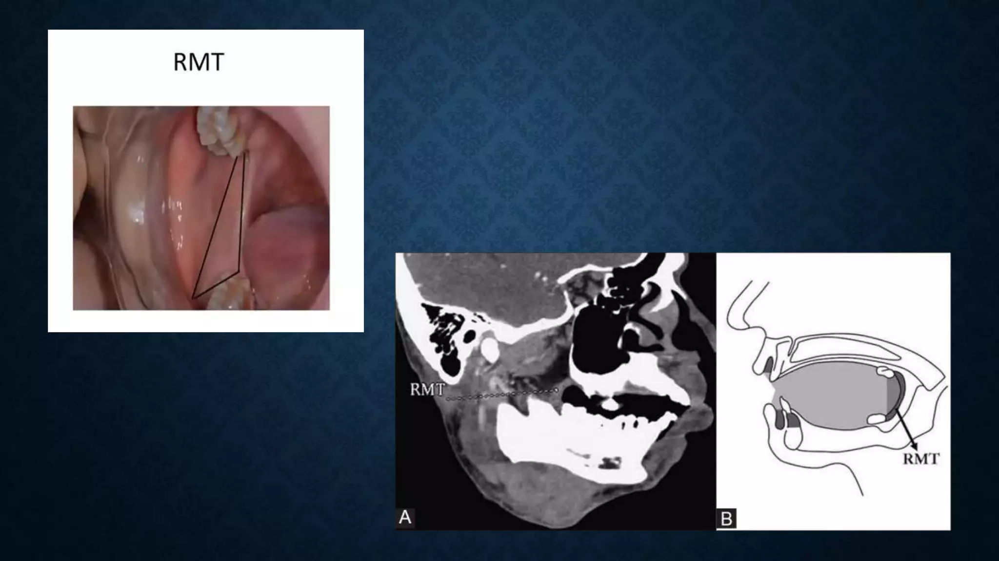 IMAGING OF ORAL CAVITY CANCER-1.pptx
