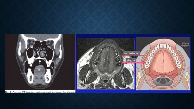 IMAGING OF ORAL CAVITY CANCER-1.pptx