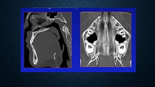 IMAGING OF ORAL CAVITY CANCER-1.pptx