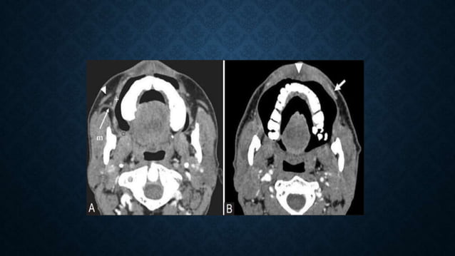 IMAGING OF ORAL CAVITY CANCER-1.pptx