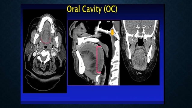 IMAGING OF ORAL CAVITY CANCER-1.pptx