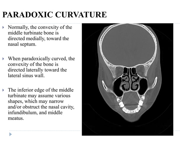 Imaging of paranasal sinuses | PPTX