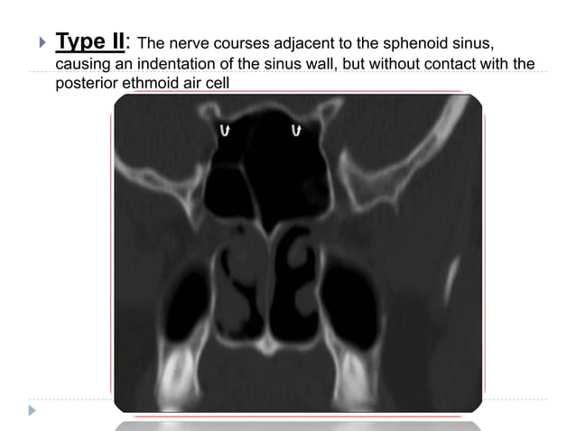 Imaging of paranasal sinuses | PPTX