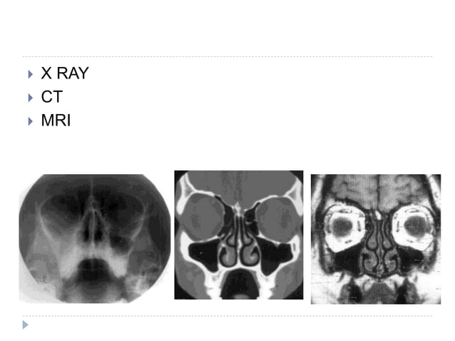 Imaging of paranasal sinuses | PPTX