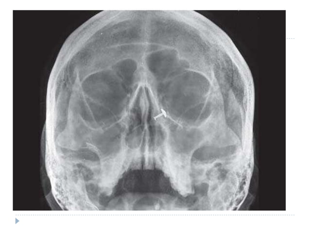 Imaging of paranasal sinuses | PPTX
