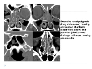 Imaging of paranasal sinuses | PPTX