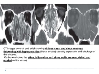 Imaging of paranasal sinuses | PPTX