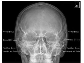 Paranasal Sinuses X Ray