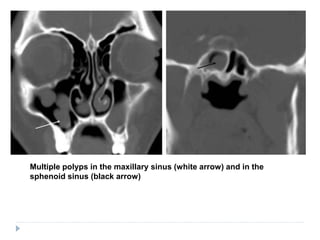 Sphenoid Sinus X Ray