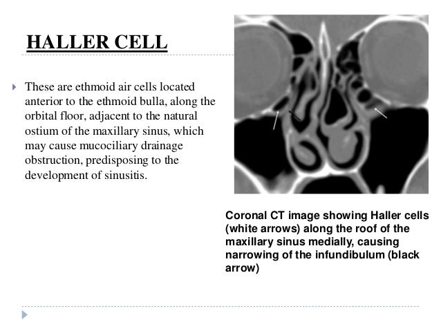 Imaging of paranasal sinuses