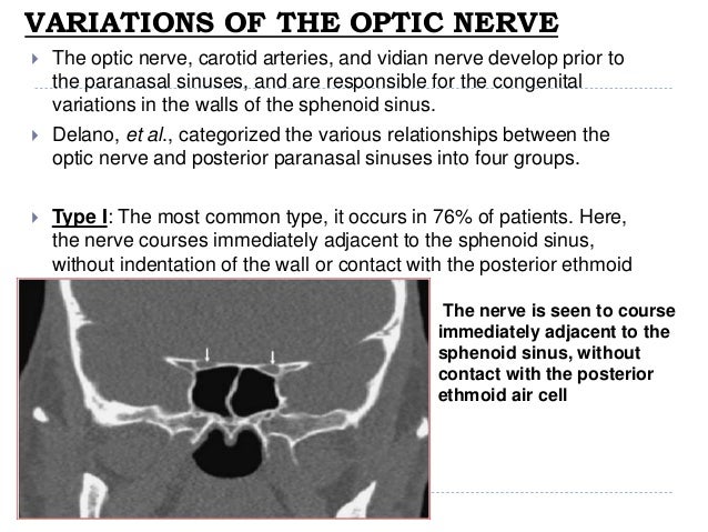 Imaging of paranasal sinuses