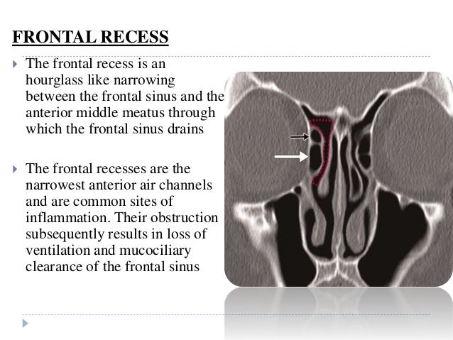 Imaging of paranasal sinuses