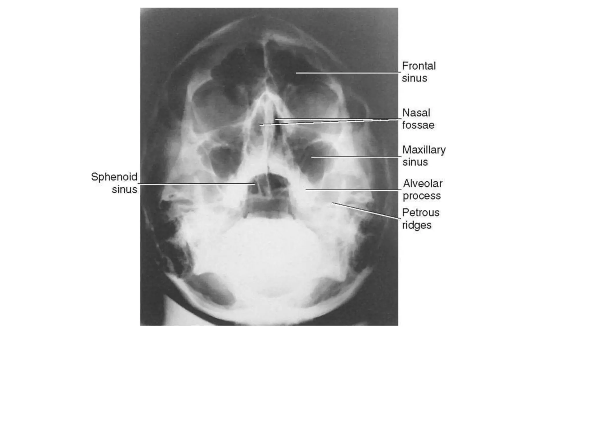 Imaging of paranasal sinuses | PPT