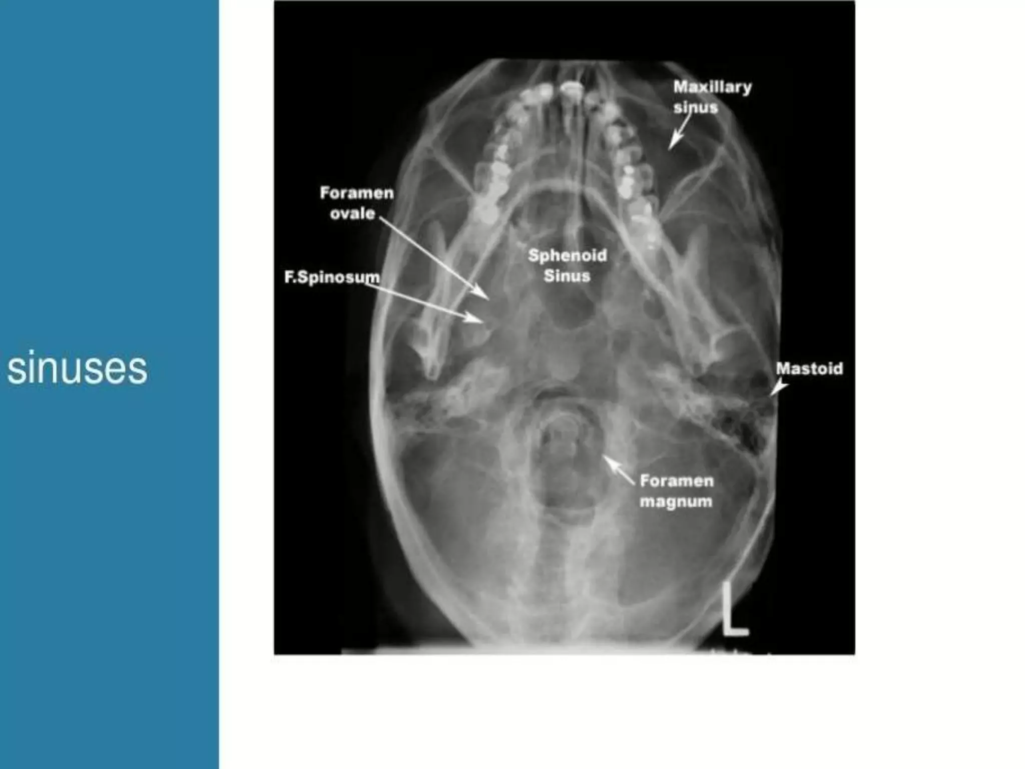 Imaging of paranasal sinuses | PPT