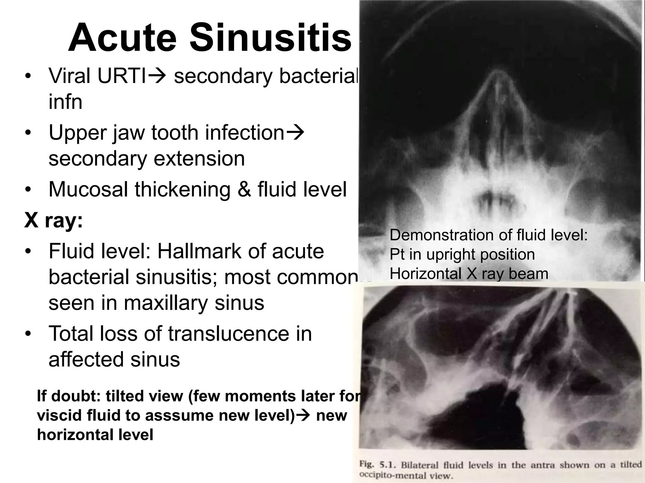 Imaging of paranasal sinuses | PPT