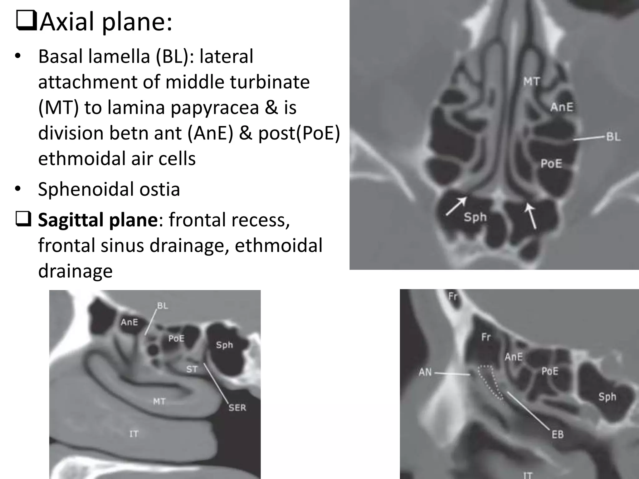 Imaging of paranasal sinuses | PPT