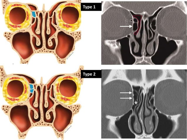 Imaging of paranasal sinuses | PPT | Ear, Nose and Throat Conditions ...