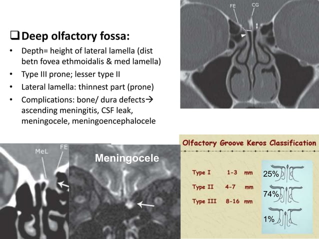 Imaging of paranasal sinuses | PPT | Ear, Nose and Throat Conditions ...