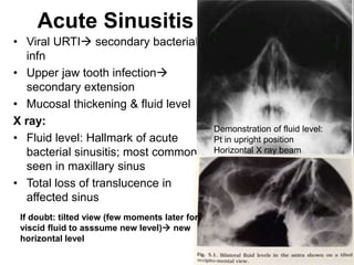 Sinus Congestion Xray