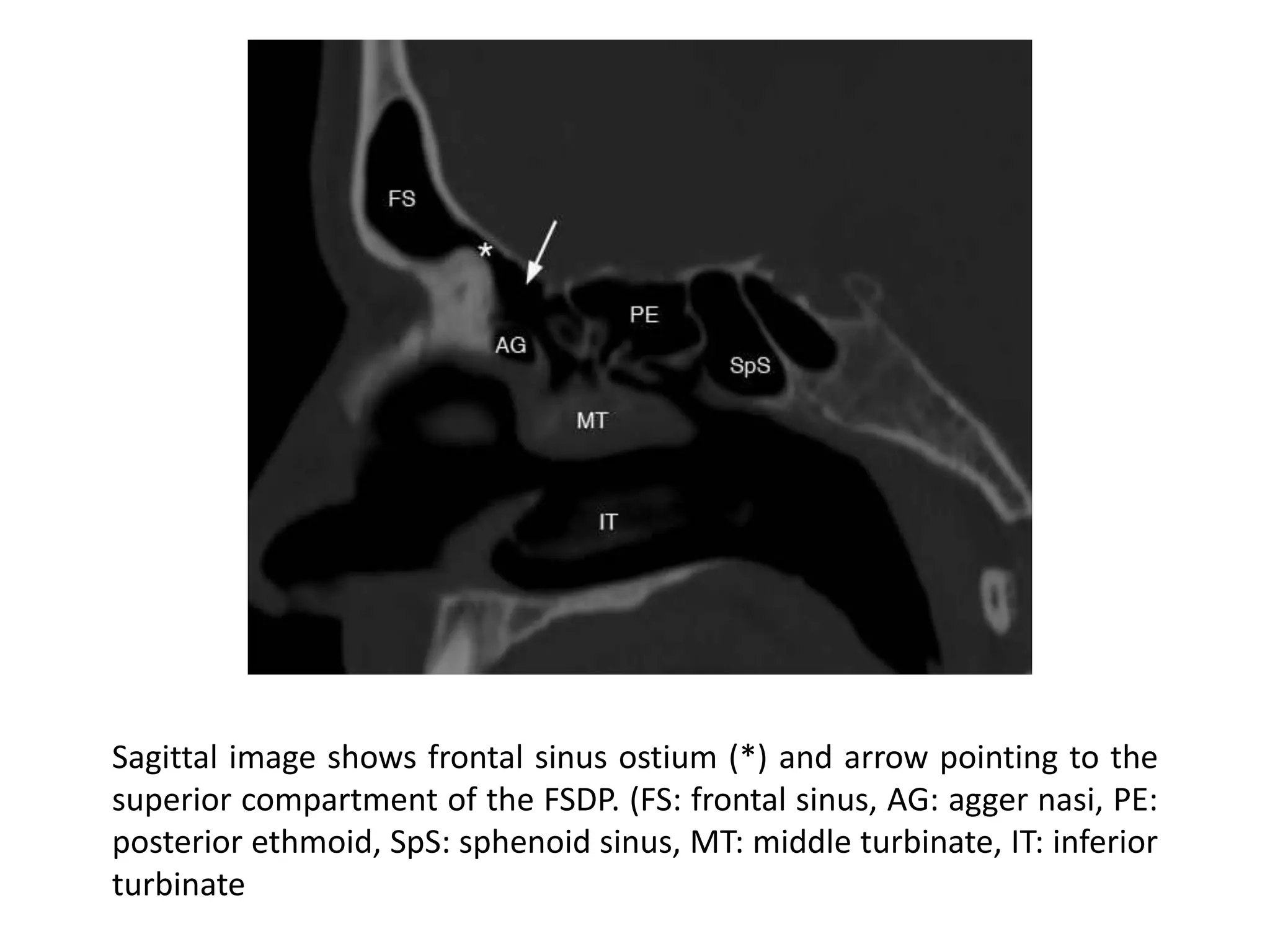 IMAGING OF PARANASAL SINUSES.ppt