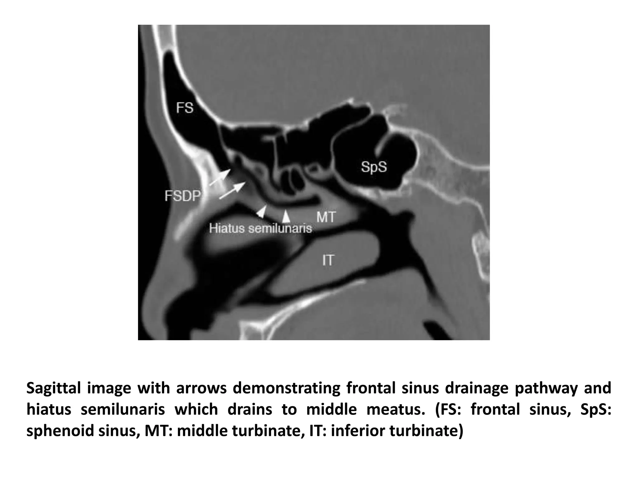 IMAGING OF PARANASAL SINUSES.ppt