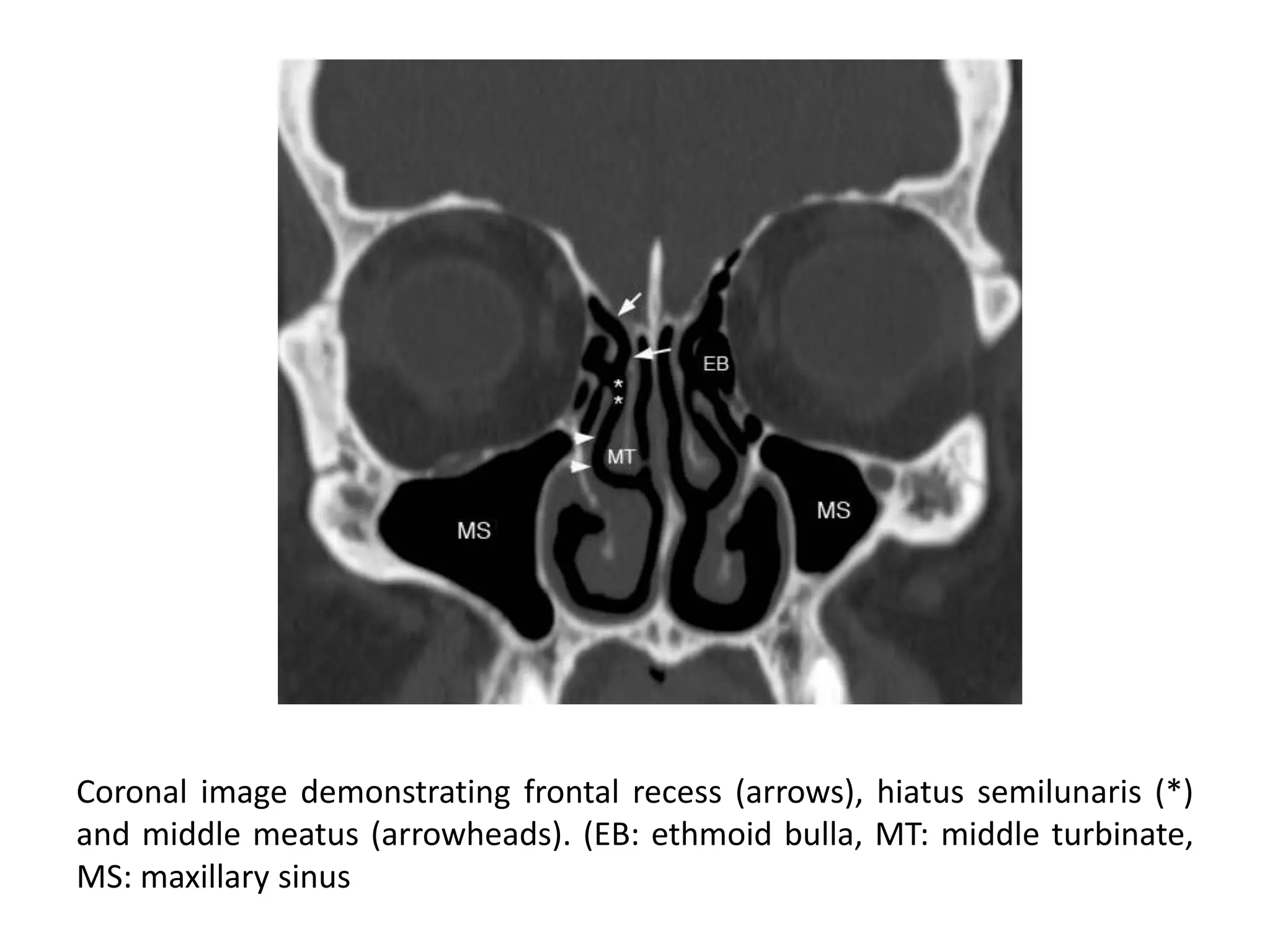 IMAGING OF PARANASAL SINUSES.ppt