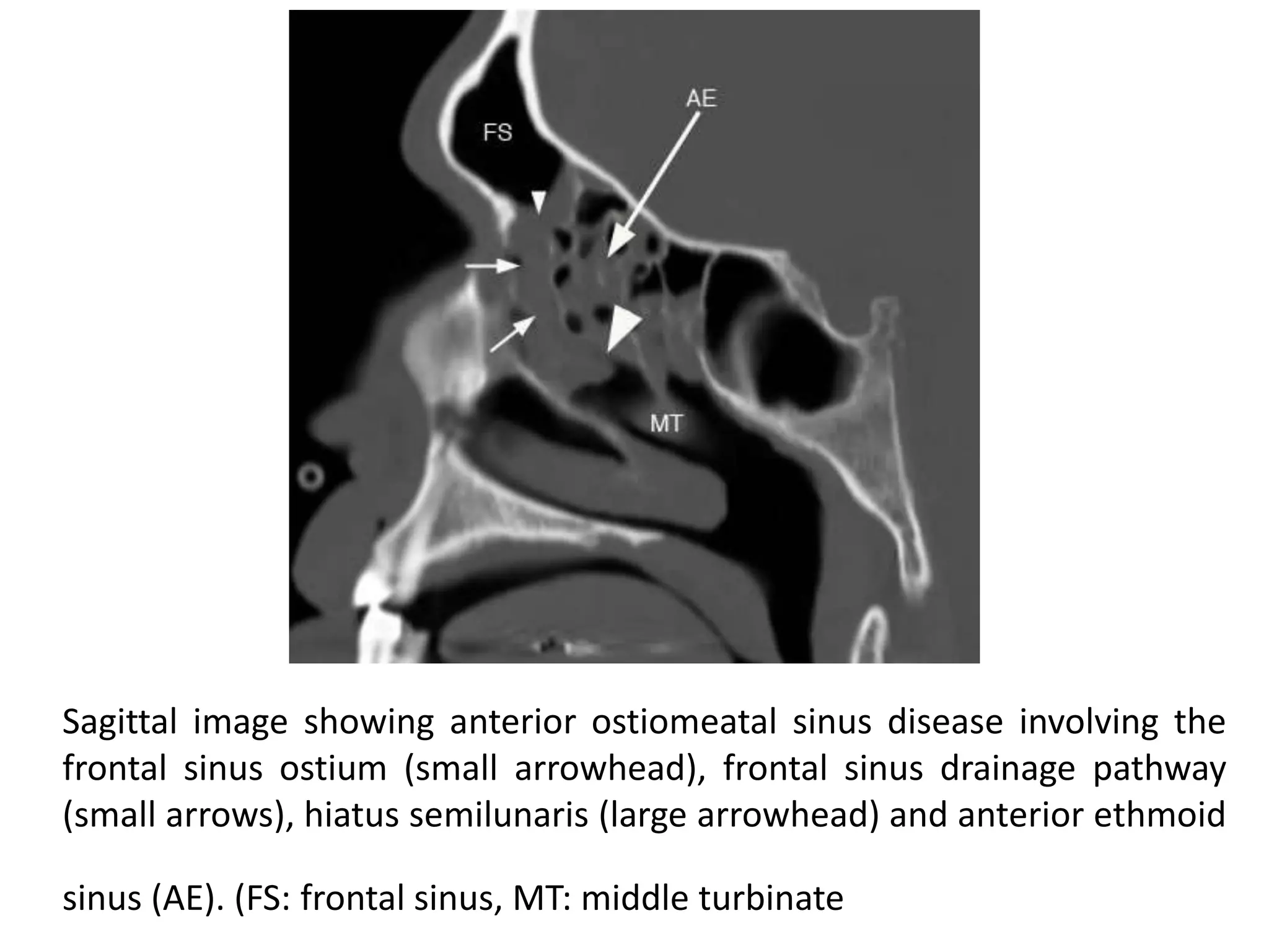 IMAGING OF PARANASAL SINUSES.ppt