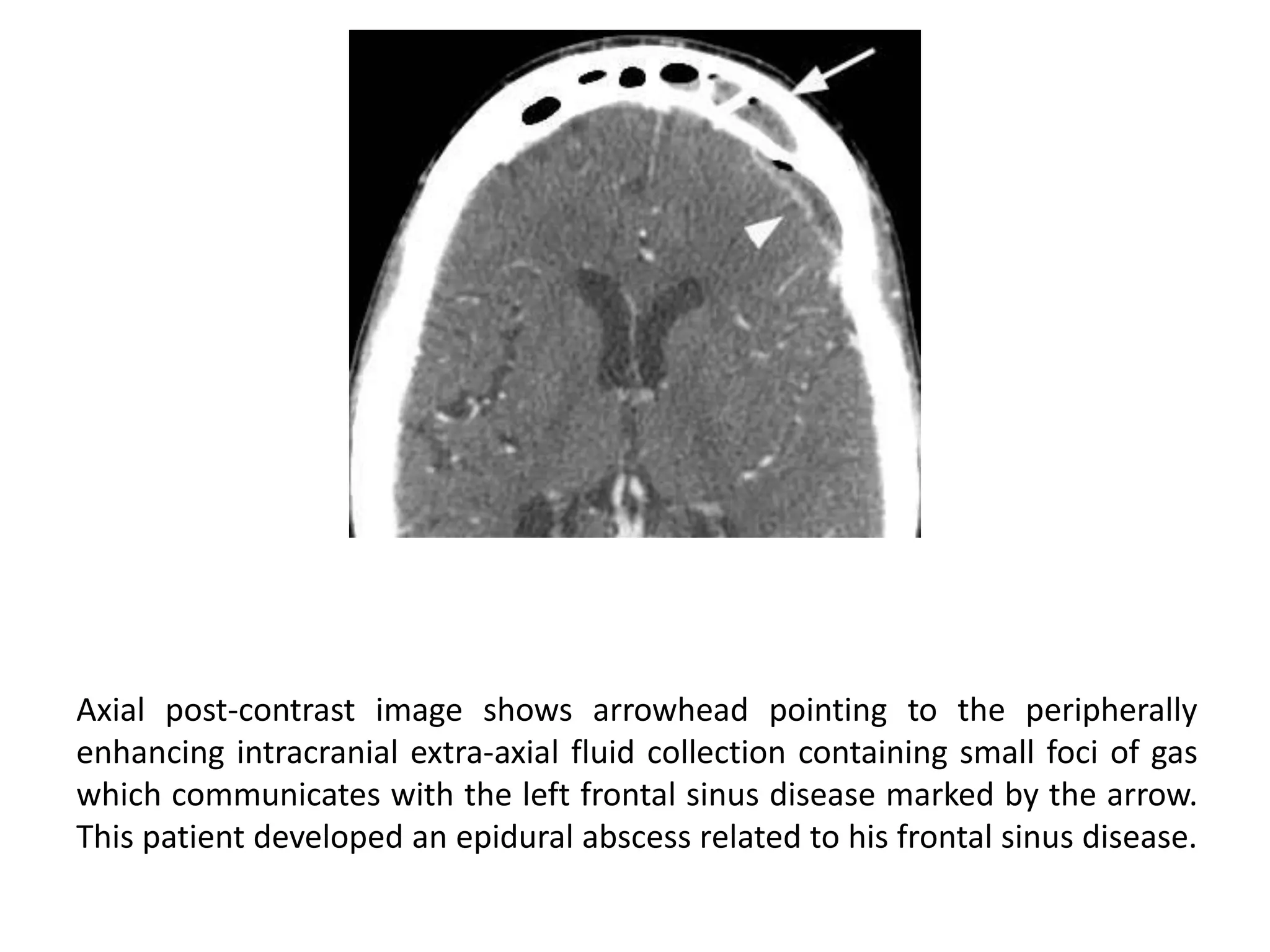 IMAGING OF PARANASAL SINUSES.ppt