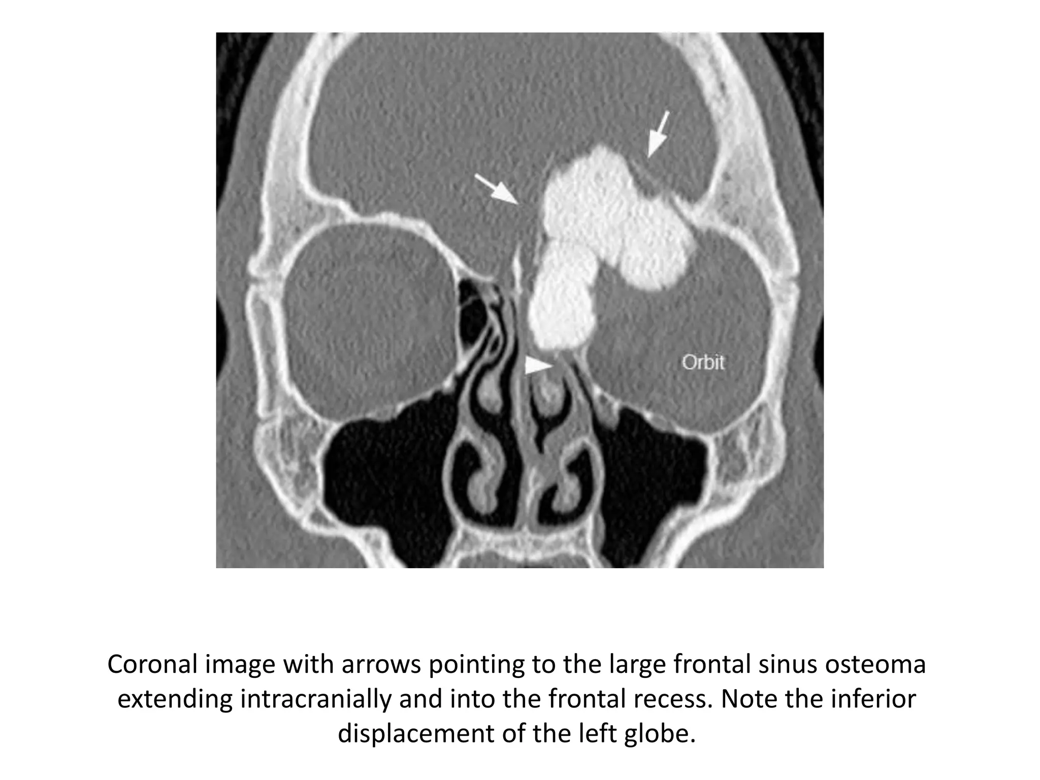 IMAGING OF PARANASAL SINUSES.ppt