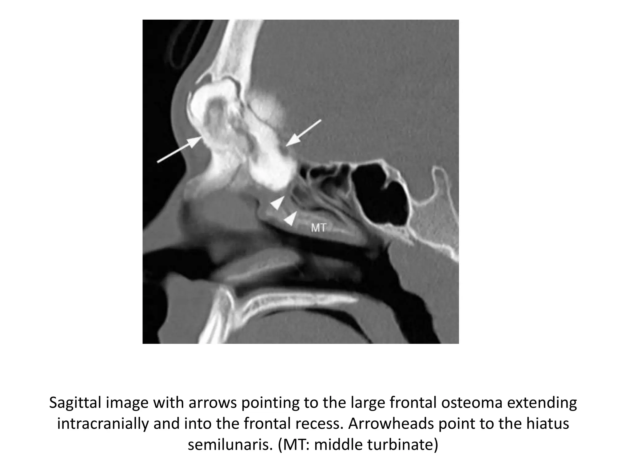 IMAGING OF PARANASAL SINUSES.ppt