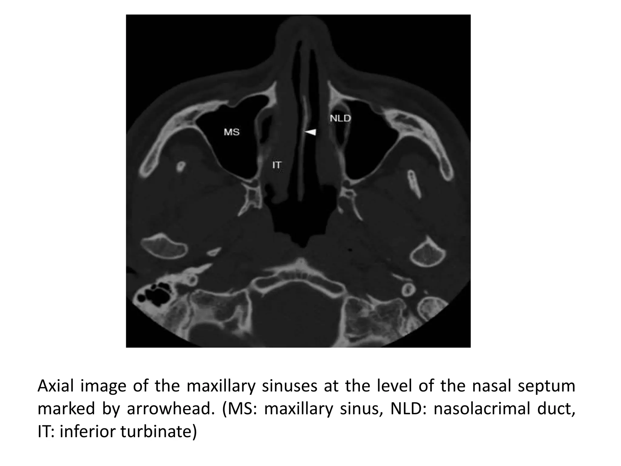 IMAGING OF PARANASAL SINUSES.ppt