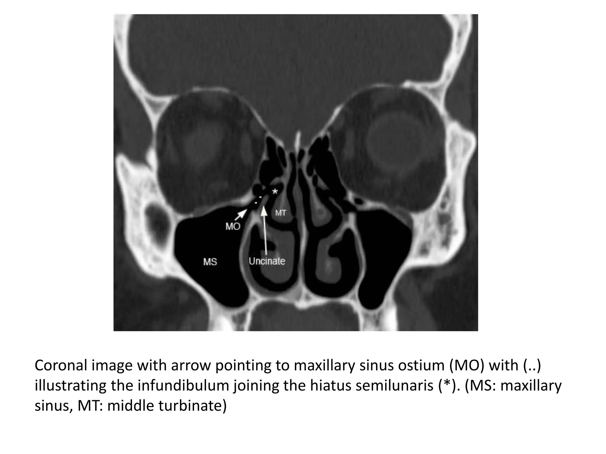 IMAGING OF PARANASAL SINUSES.ppt