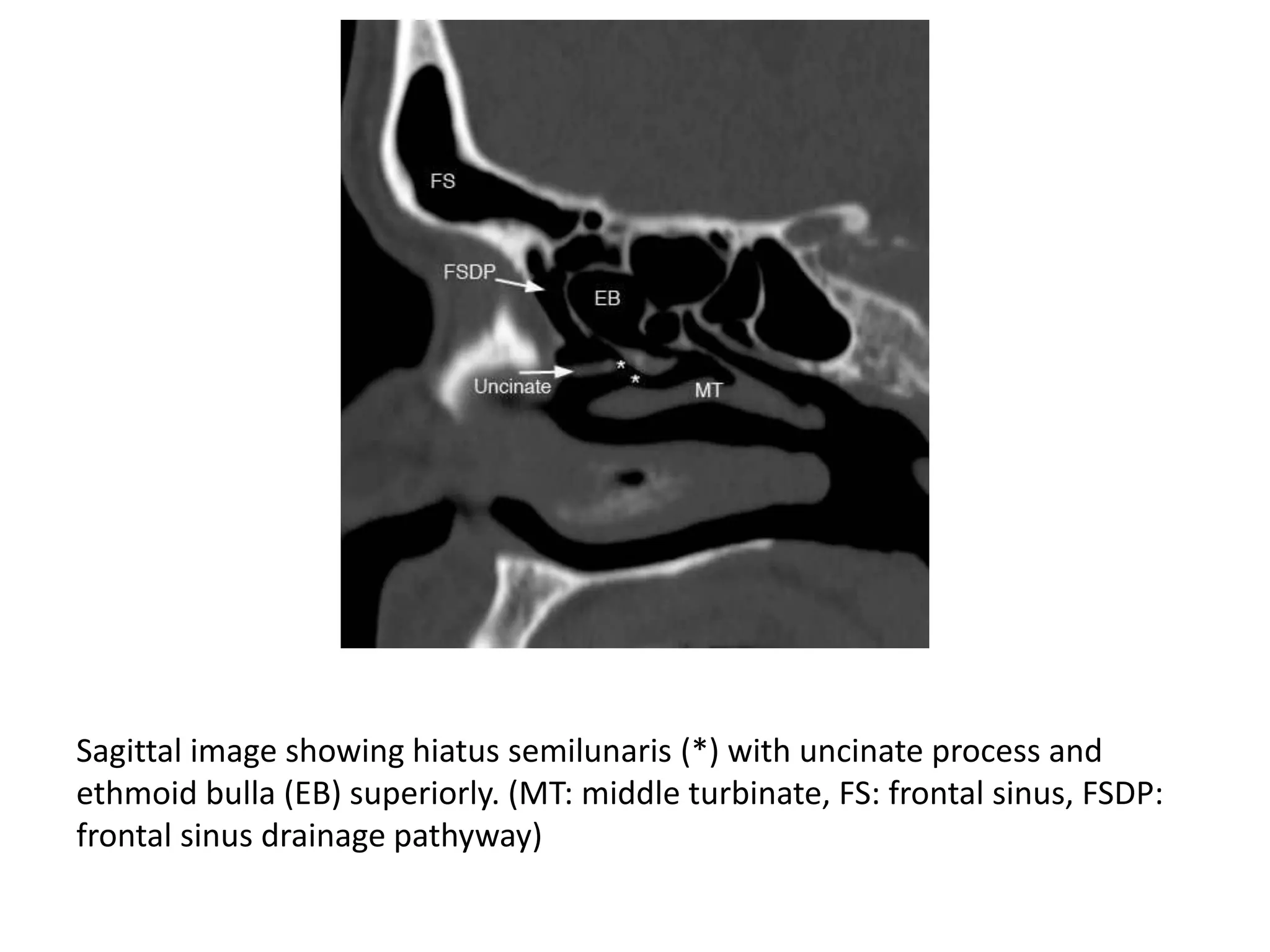IMAGING OF PARANASAL SINUSES.ppt
