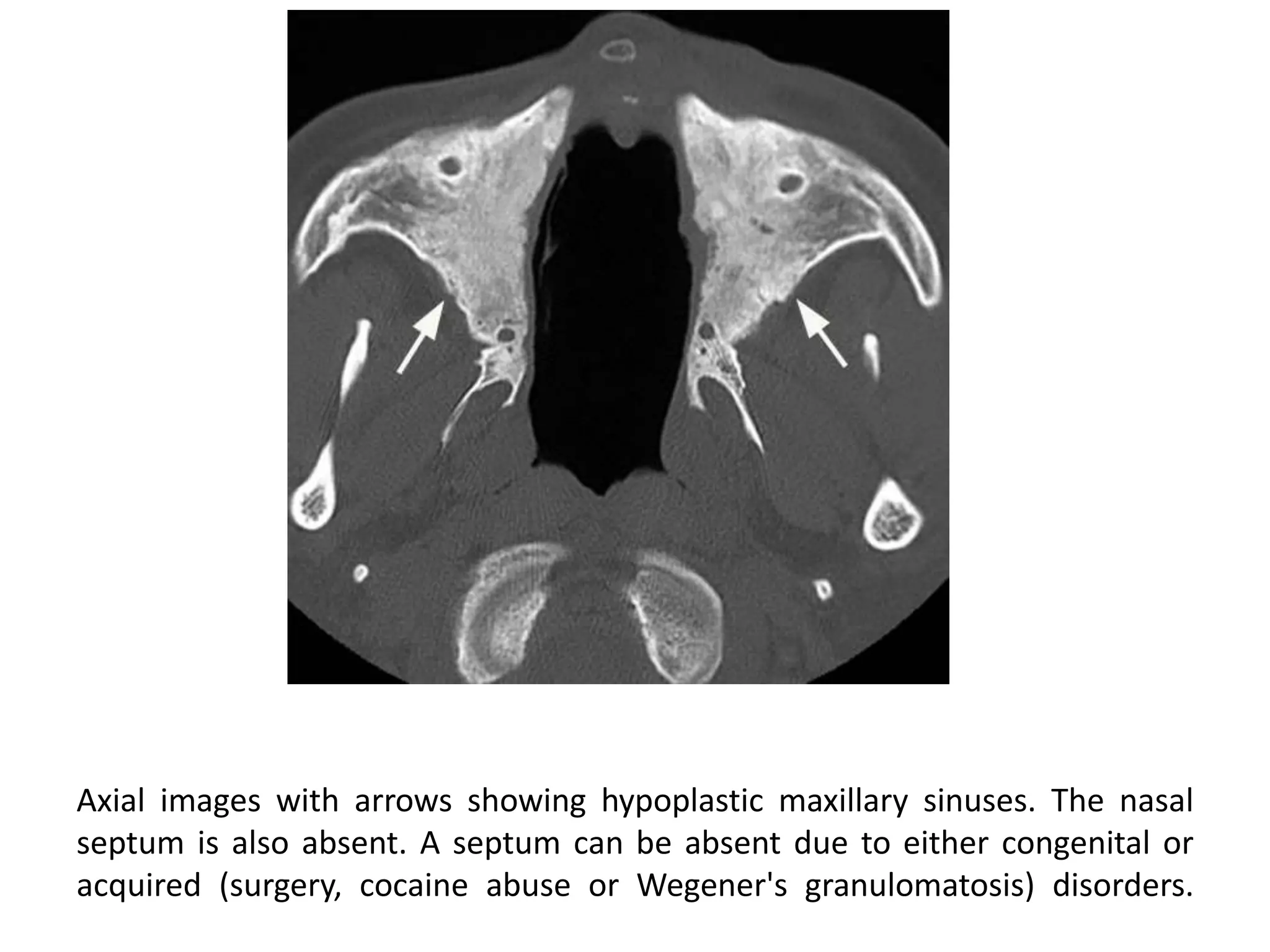 IMAGING OF PARANASAL SINUSES.ppt